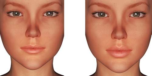 Allo Derm Mesh Lawsuit Lawyer in Fort Lauderdale | No Win, No Fee ...